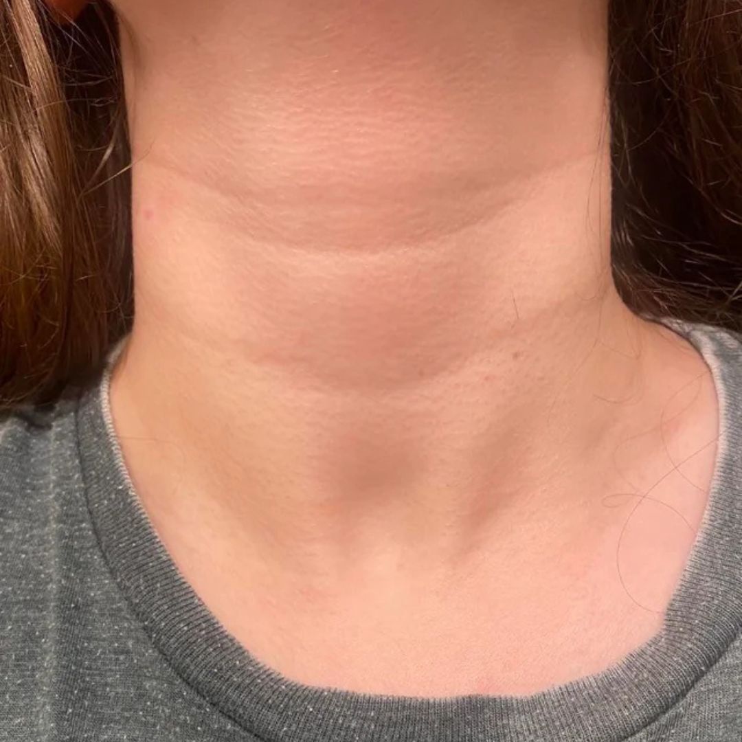 How to Remove Neck Lines Permanently - Dermatologist in Roorkee