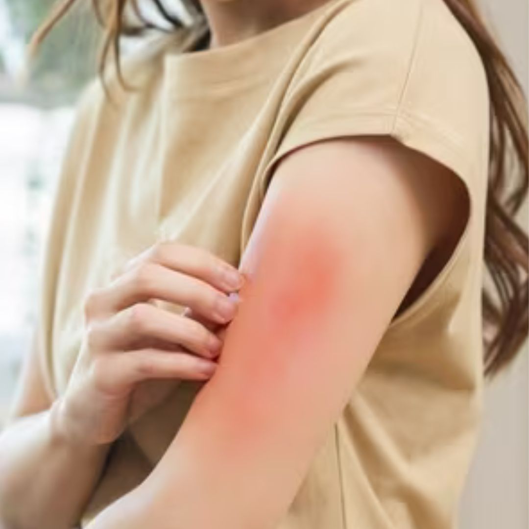 Monsoon Skin Issues and How to Prevent Them - Dermatologist in Roorkee