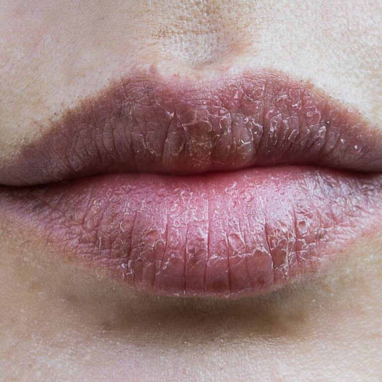 Chapped Lips in Winter: Why They Happen & How to Treat Them ...