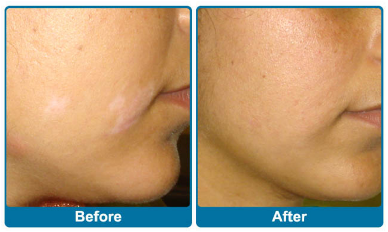 Skin Graft for Vitiligo: A Detailed Guide to Treatment, Results, and ...